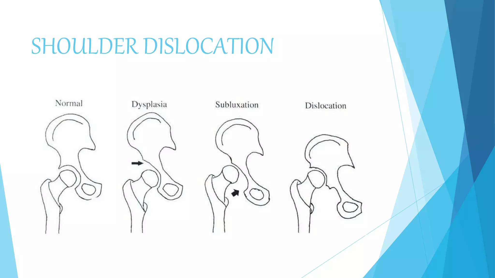 JOINT DISLOCATION.pptx