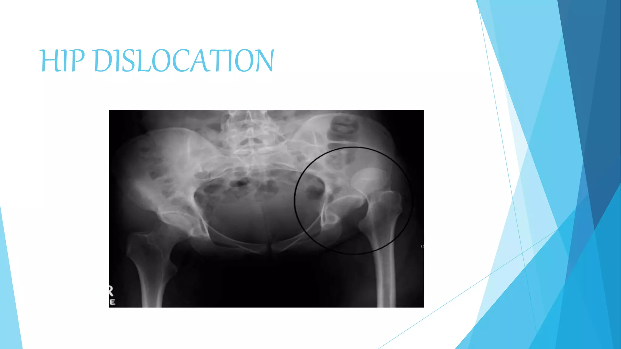 JOINT DISLOCATION.pptx
