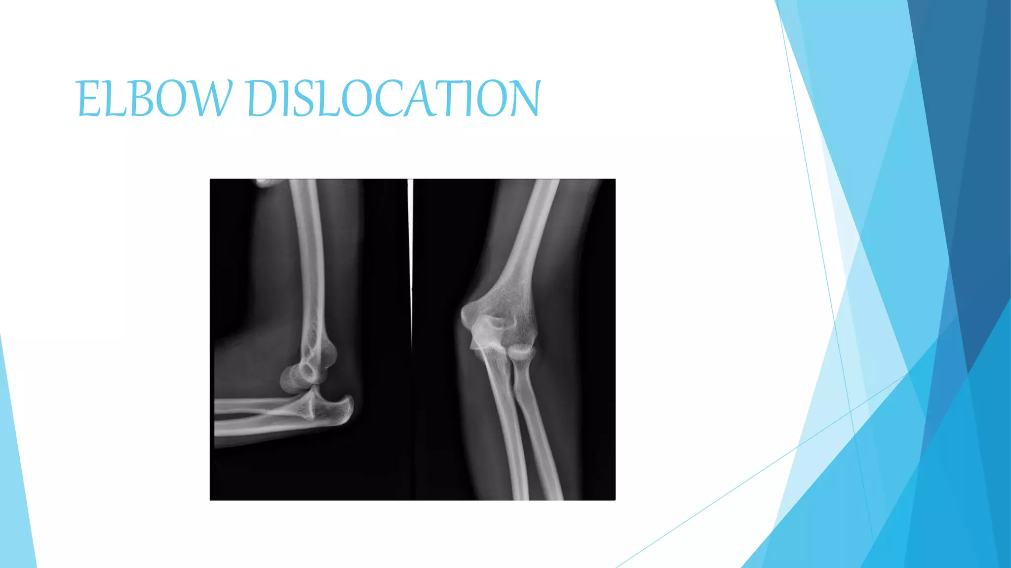 JOINT DISLOCATION.pptx