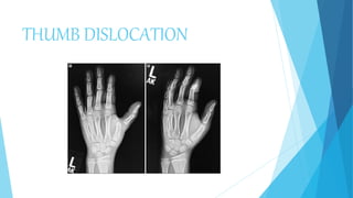 JOINT DISLOCATION.pptx