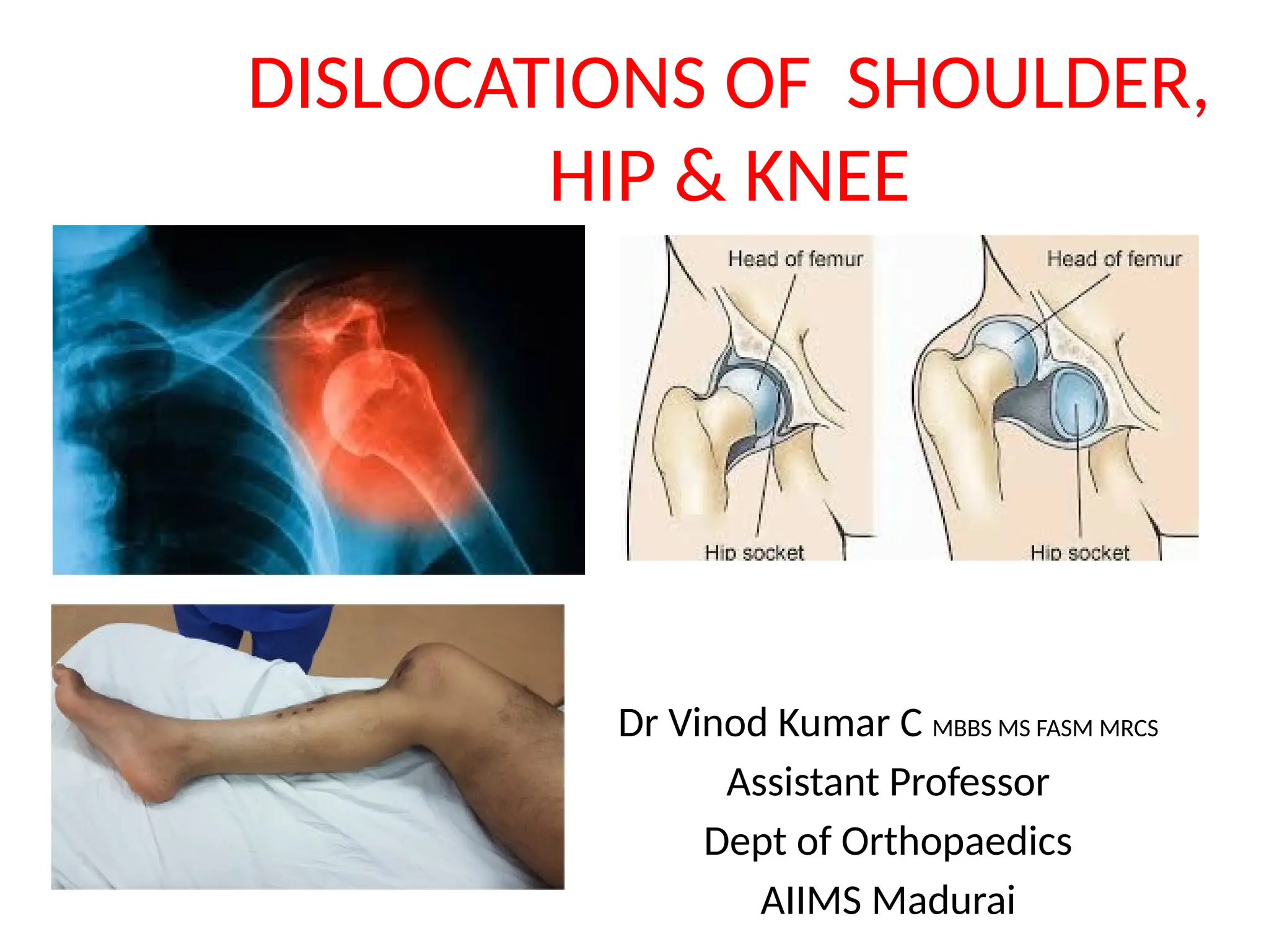 Dislocation of major joints ( Shoulder , hip and knee) | PPTX