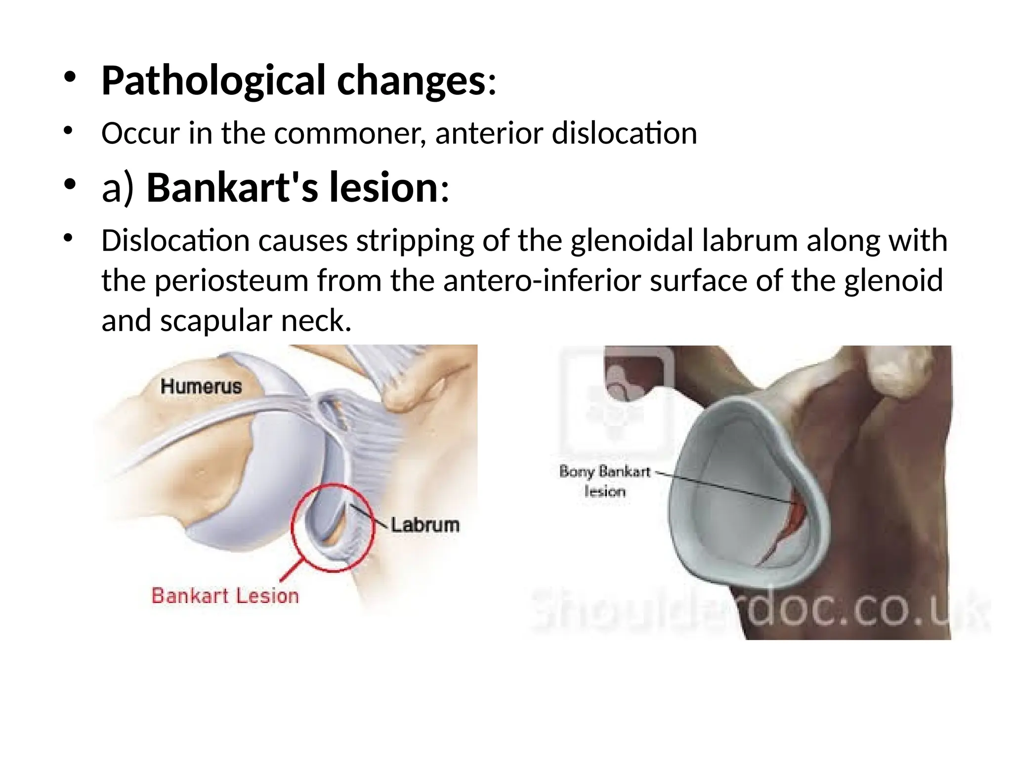 Dislocation of major joints ( Shoulder , hip and knee) | PPTX
