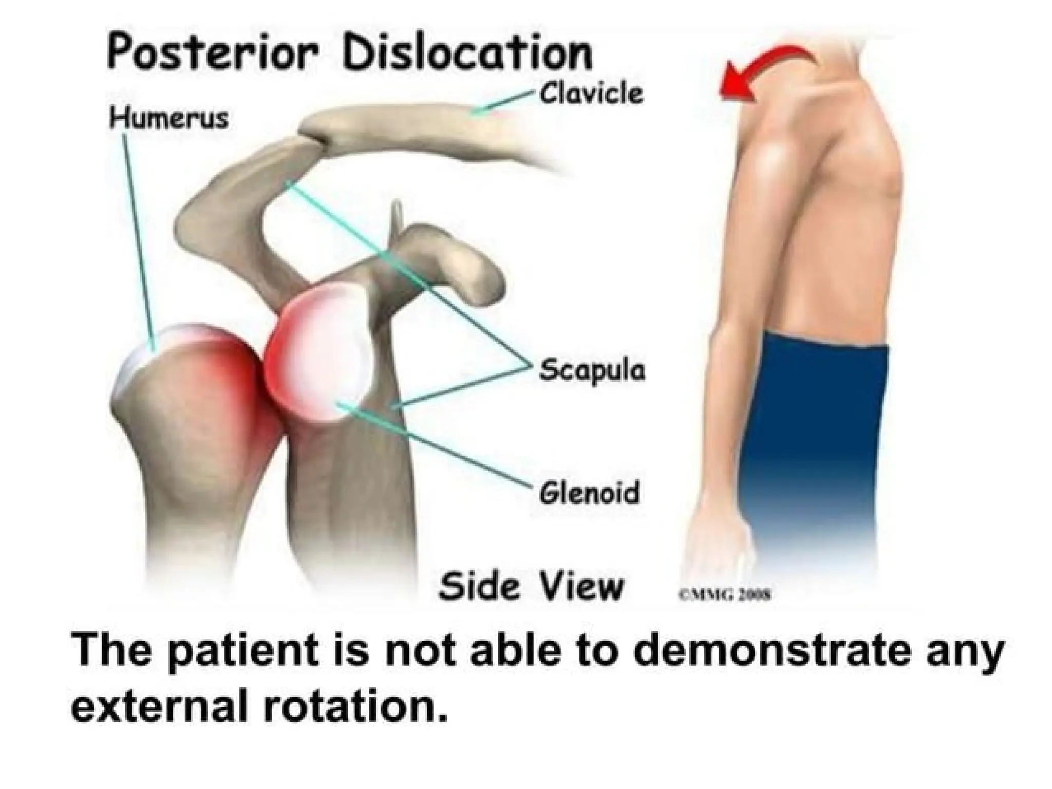 Dislocation of major joints ( Shoulder , hip and knee) | PPTX