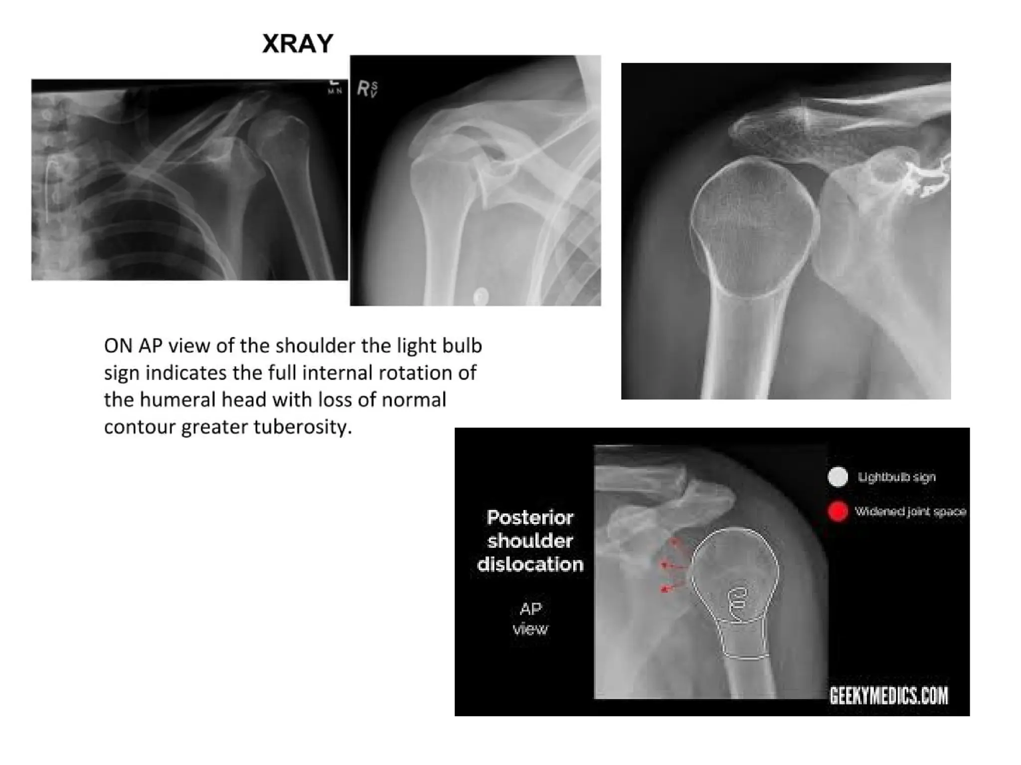 Dislocation of major joints ( Shoulder , hip and knee) | PPTX