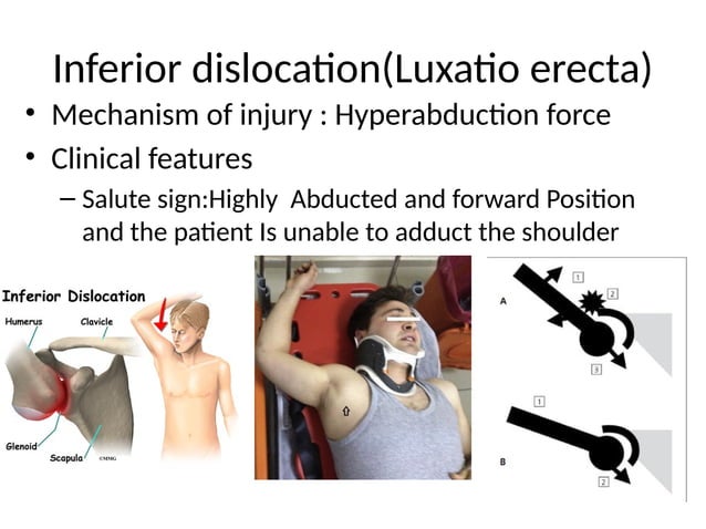 Dislocation of major joints ( Shoulder , hip and knee) | PPTX