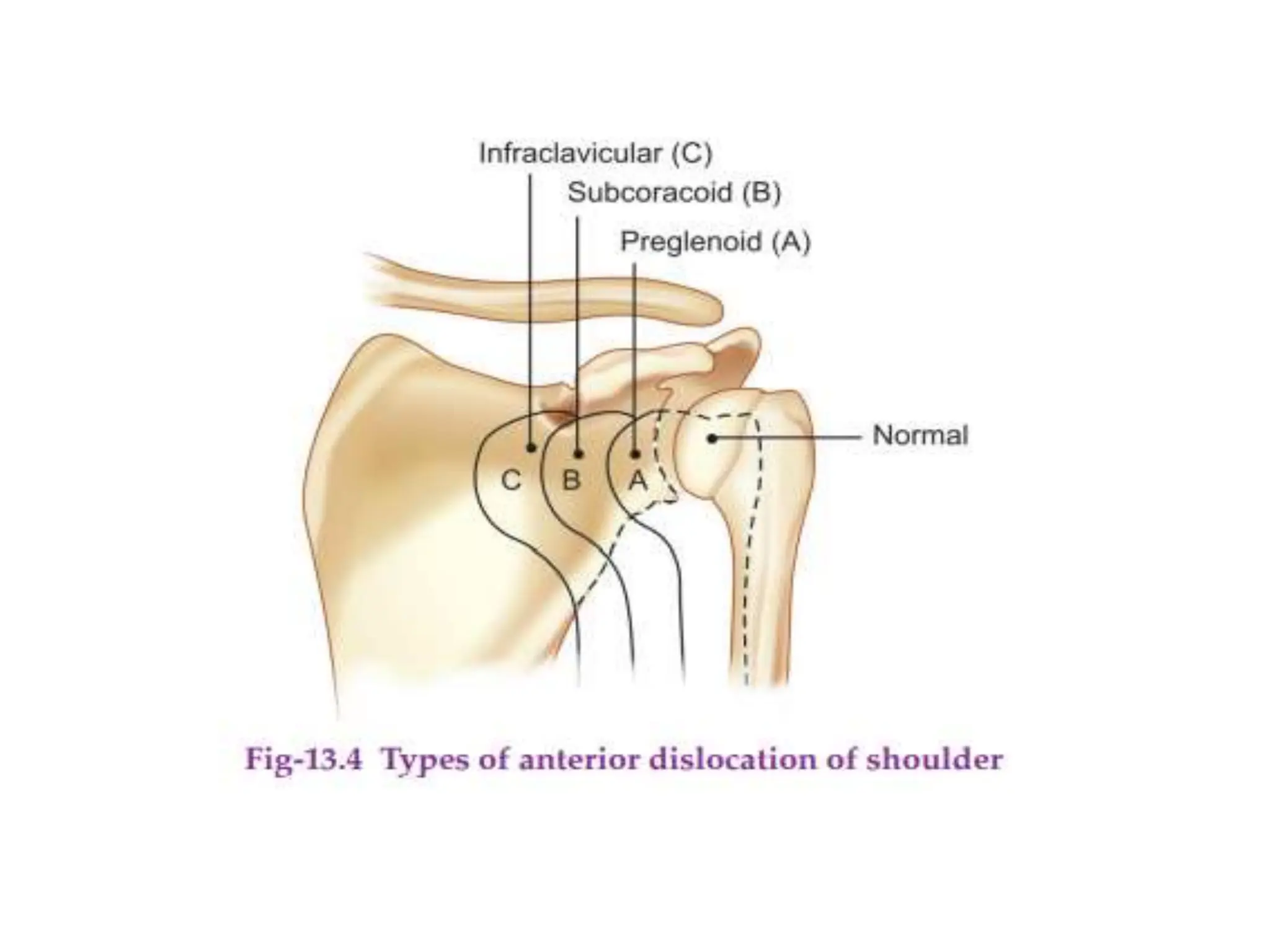 JOINT DISLOCATION of hip knee and shoulder PART-2.pptx