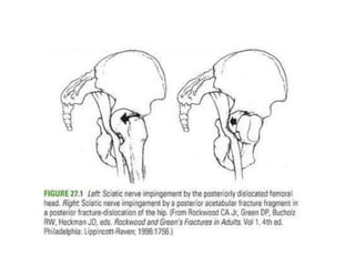 JOINT DISLOCATION of hip knee and shoulder PART-2.pptx