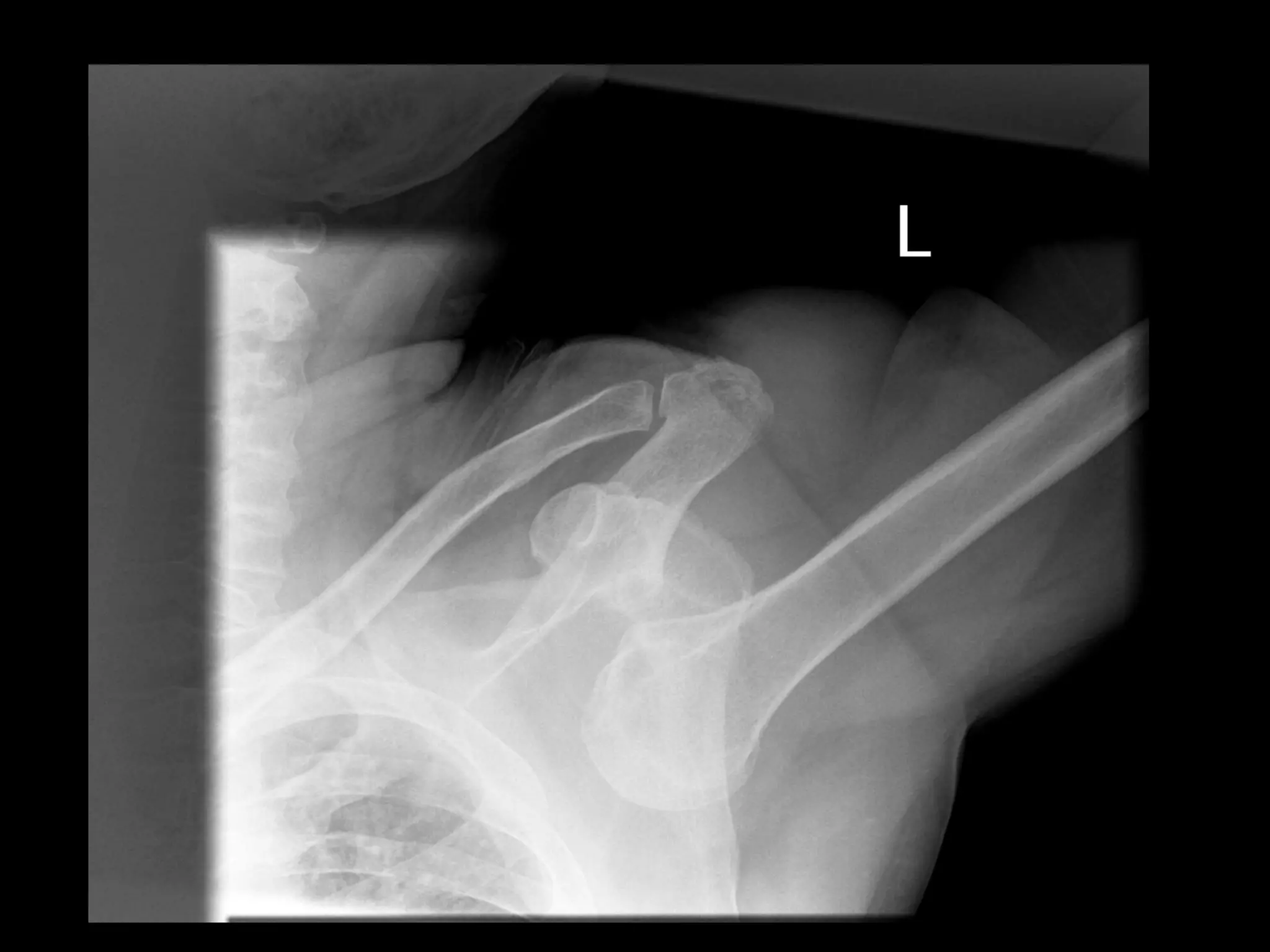 Joint dislocations | PPTX