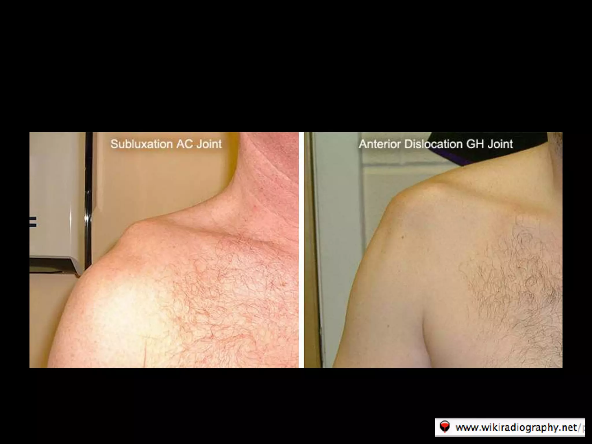 Joint dislocations | PPTX