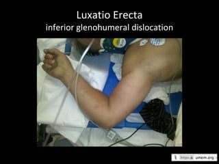 Joint dislocations | PPTX