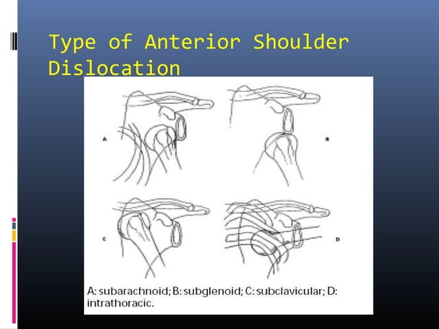 Joint dislocations for medical student | PPT