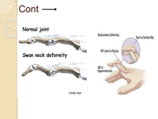 Joint disorders | PPTX