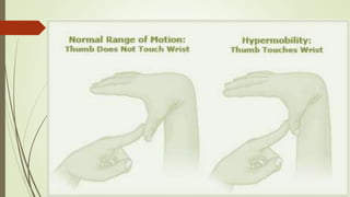 Joint Hyper mobility Syndrome | PPTX