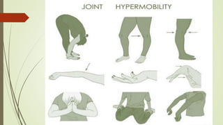 Joint Hyper mobility Syndrome | PPTX