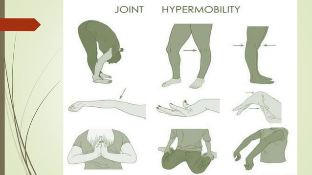 Joint Hyper mobility Syndrome | PPTX