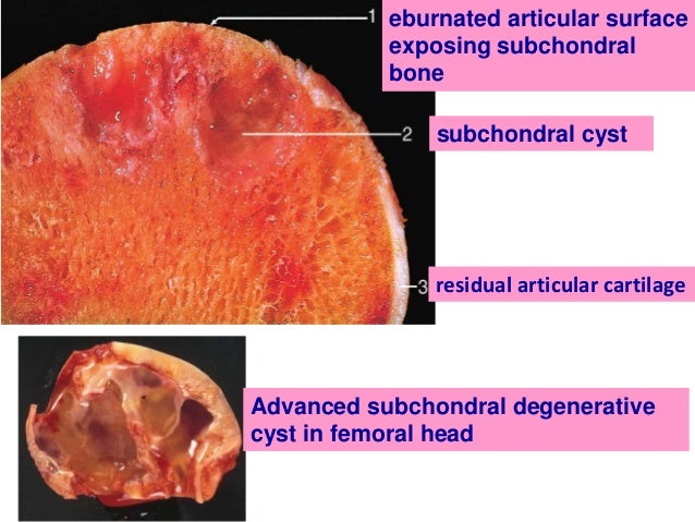 Joint pathology