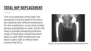 Joint Replacement Surgery in orthopedics.pdf