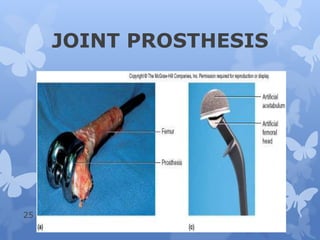 Joints | PPT
