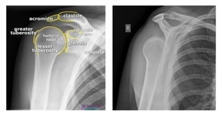 Joints of Upper Limb-Applied aspect.pptx