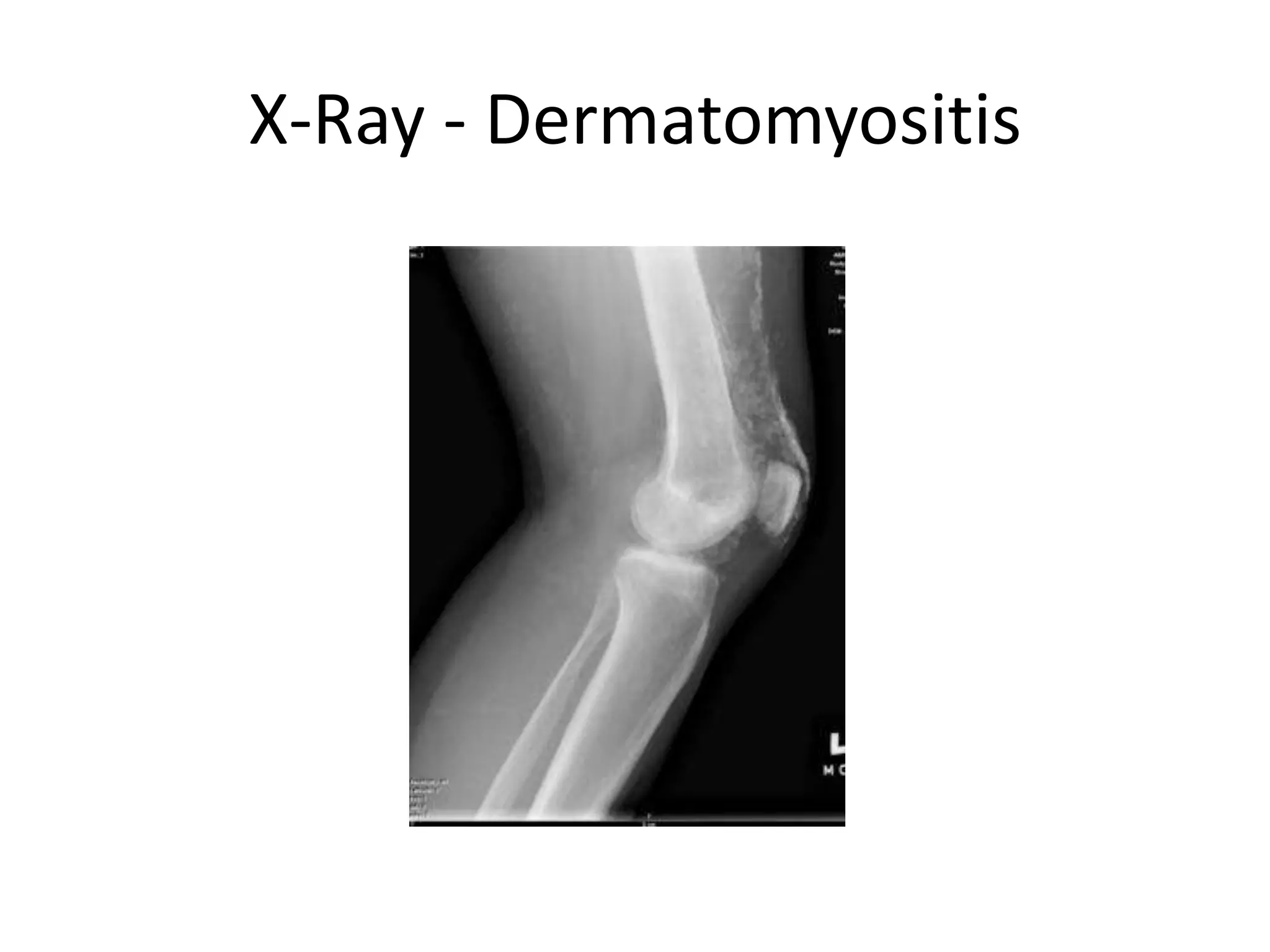 Joint syndrome differential diagnosis between scleroderma ...