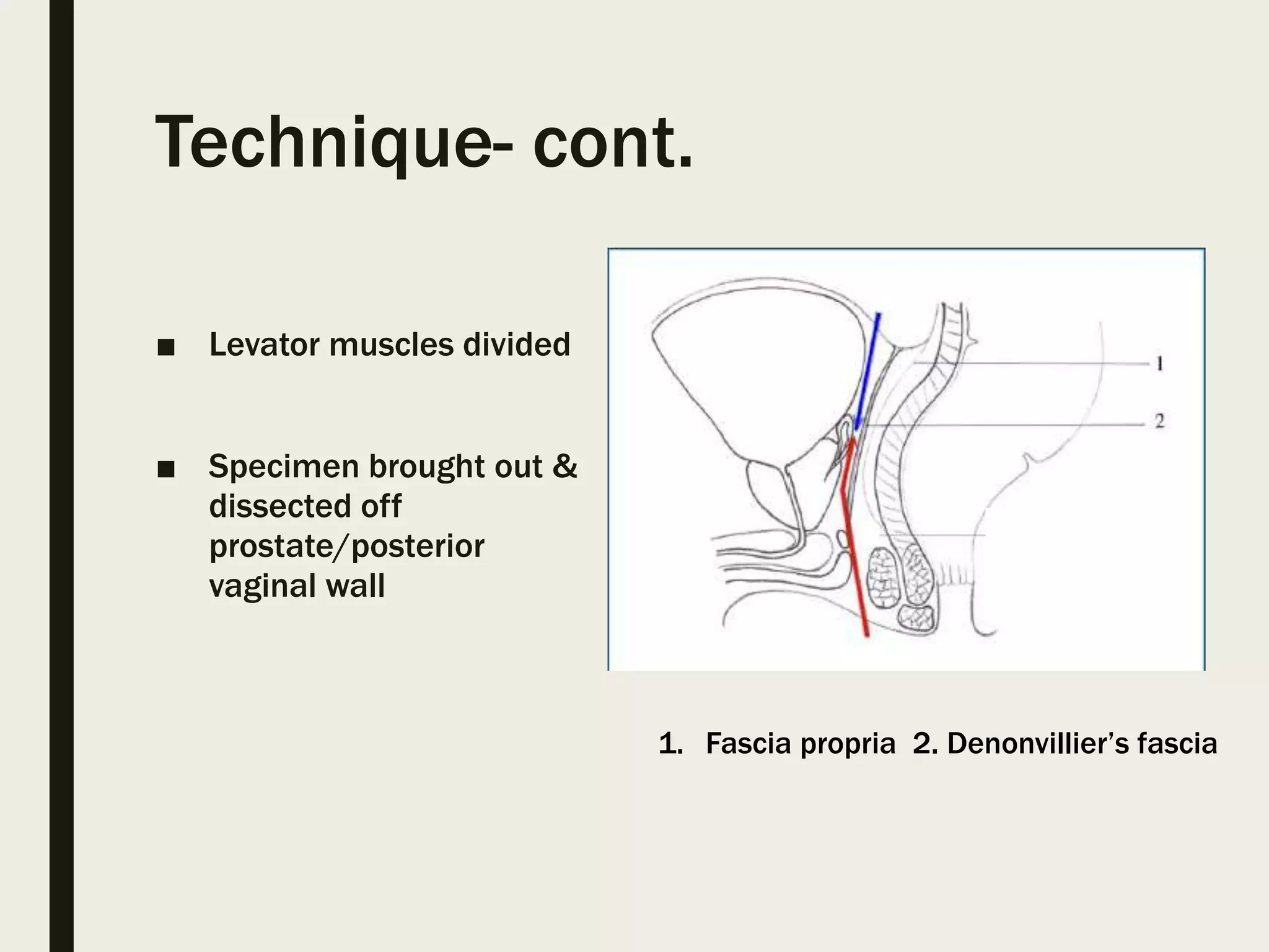 Extra Levator Abdomino Perineal Resection | PPTX