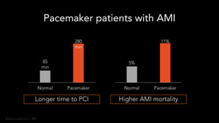 Sgarbossa criteria for ventricular paced rhythm | PDF