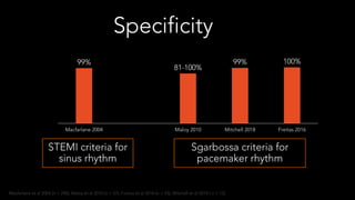 Sgarbossa criteria for ventricular paced rhythm | PDF