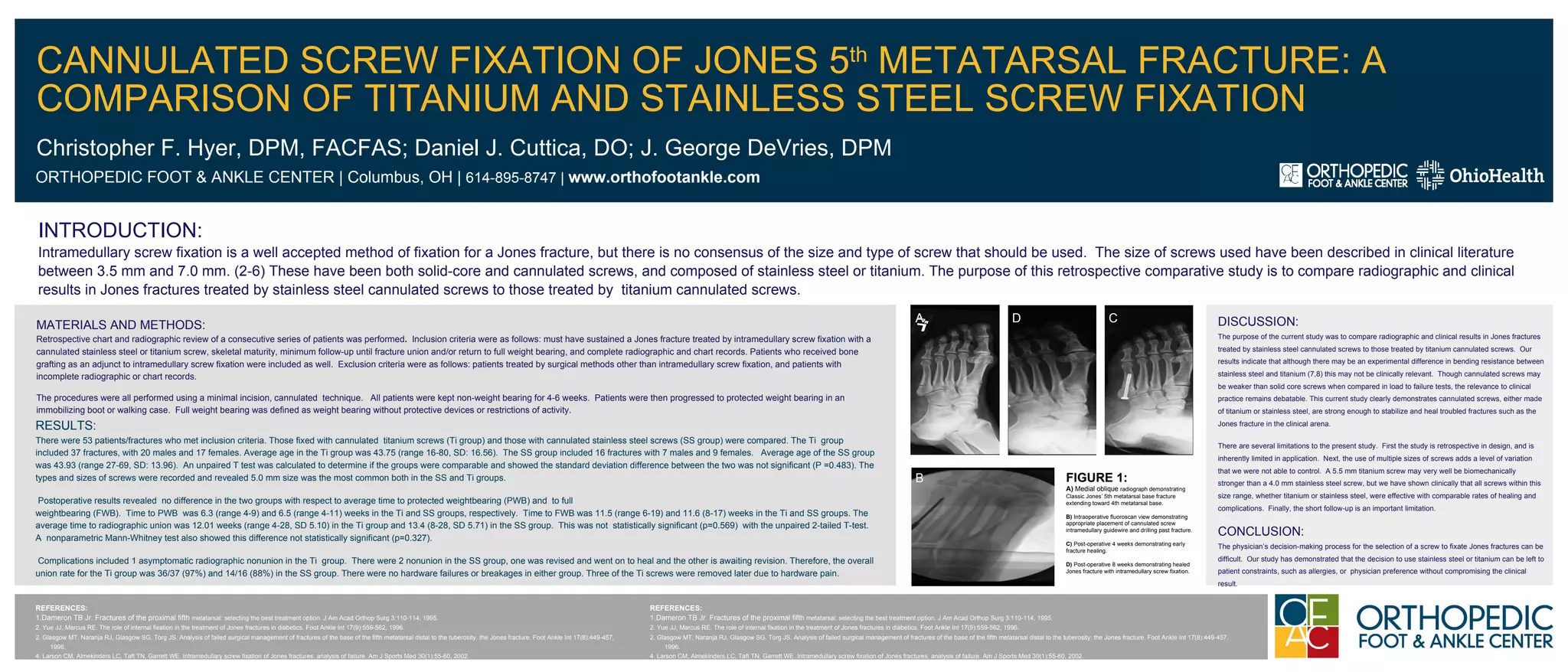 Cannulated Screw Fixation of Jones 5th Metatarsal Fracture: Comparison ...