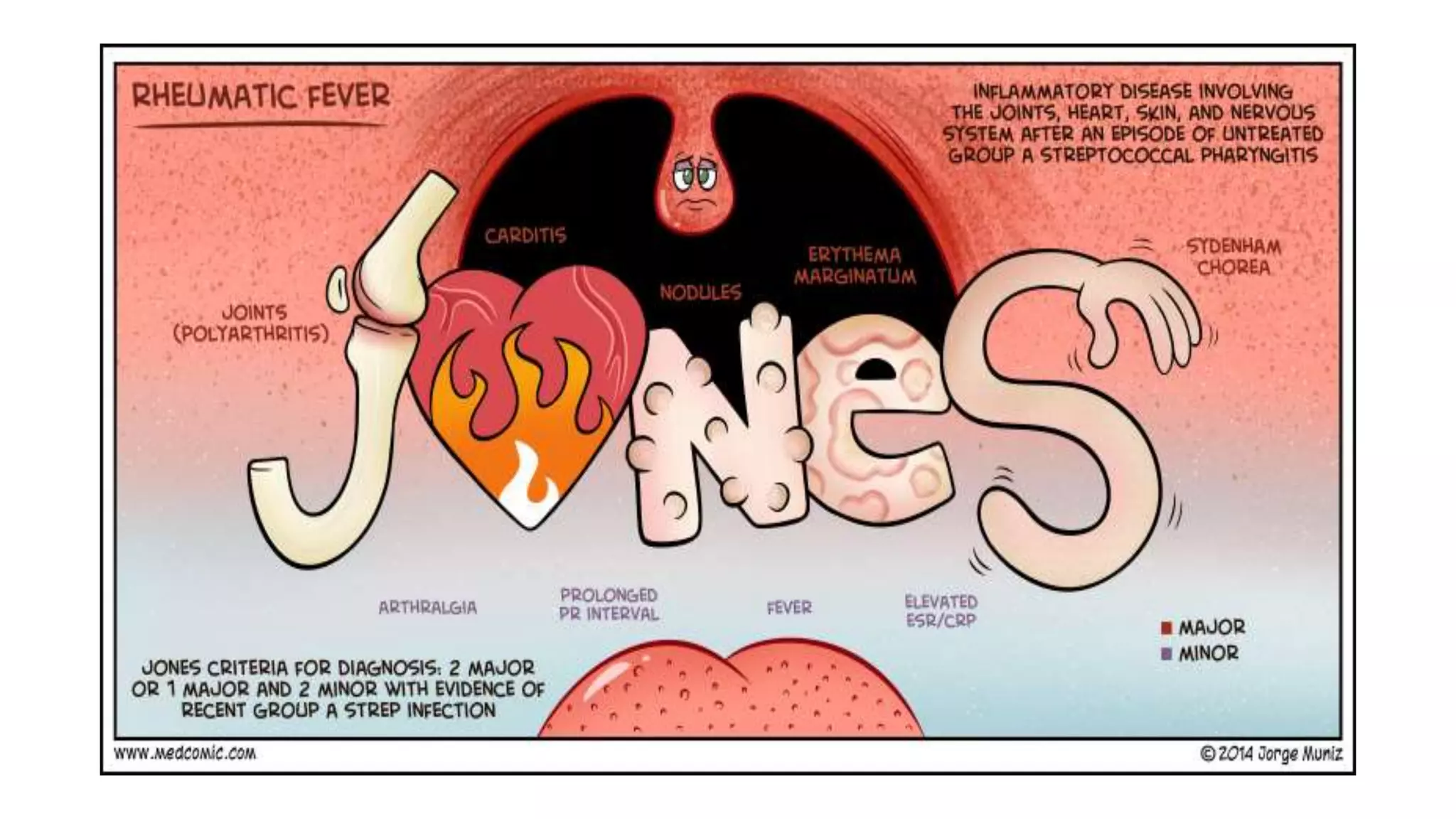 Jones criteria | PPTX