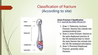 Jone's fracture by Dr.Mahbub | PPTX