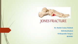 Jone's fracture by Dr.Mahbub | PPTX