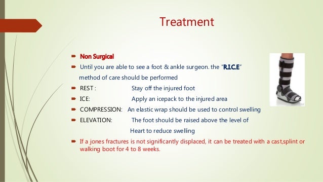 Jones fracture treatment - trustedgulu