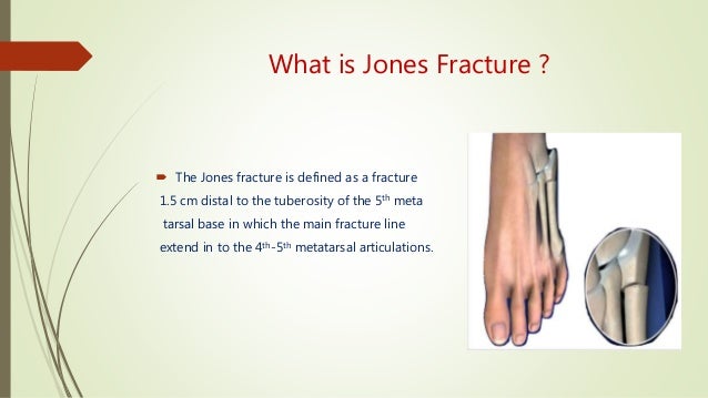 Jone's fracture by Dr.Mahbub
