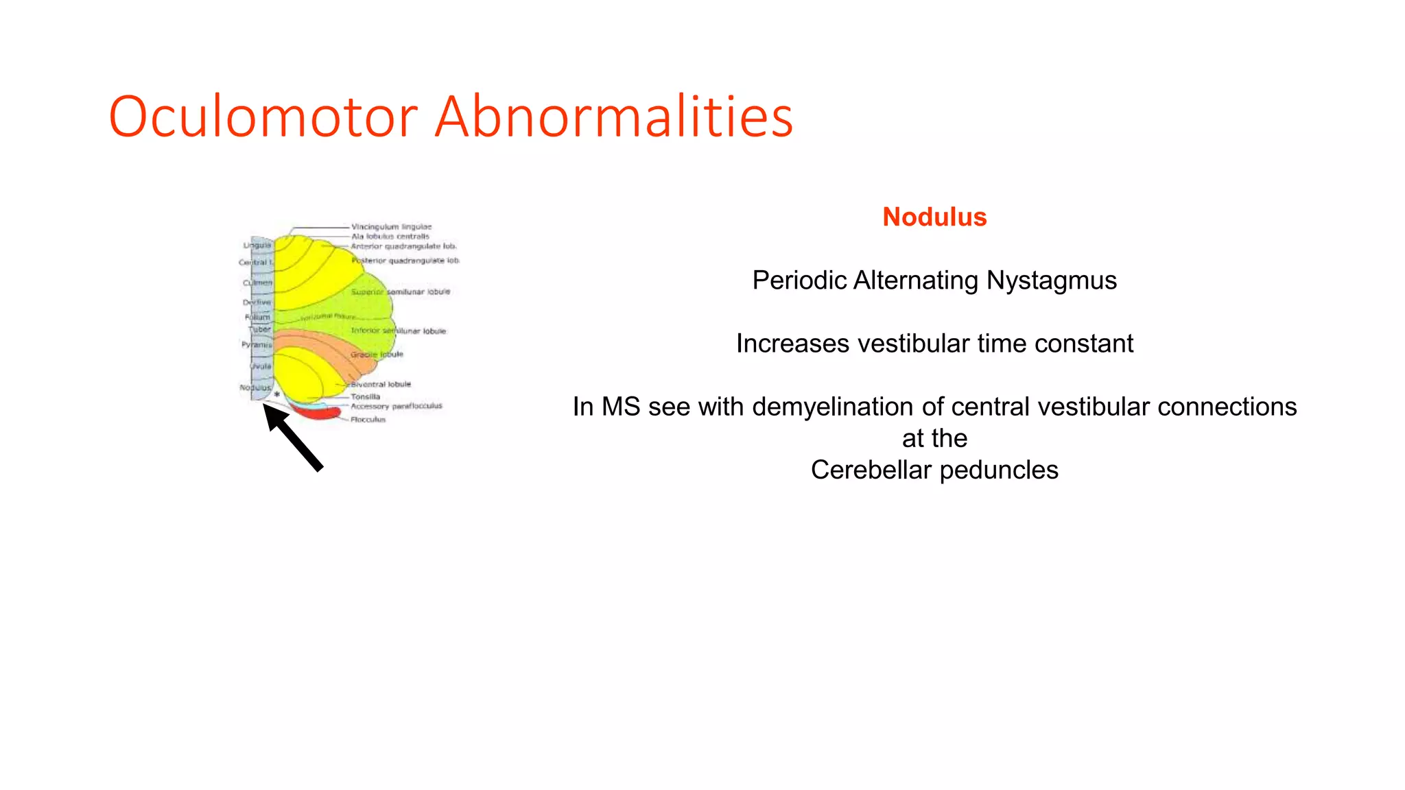 Cerebellar Ataxia in Multiple Sclerosis | PPTX