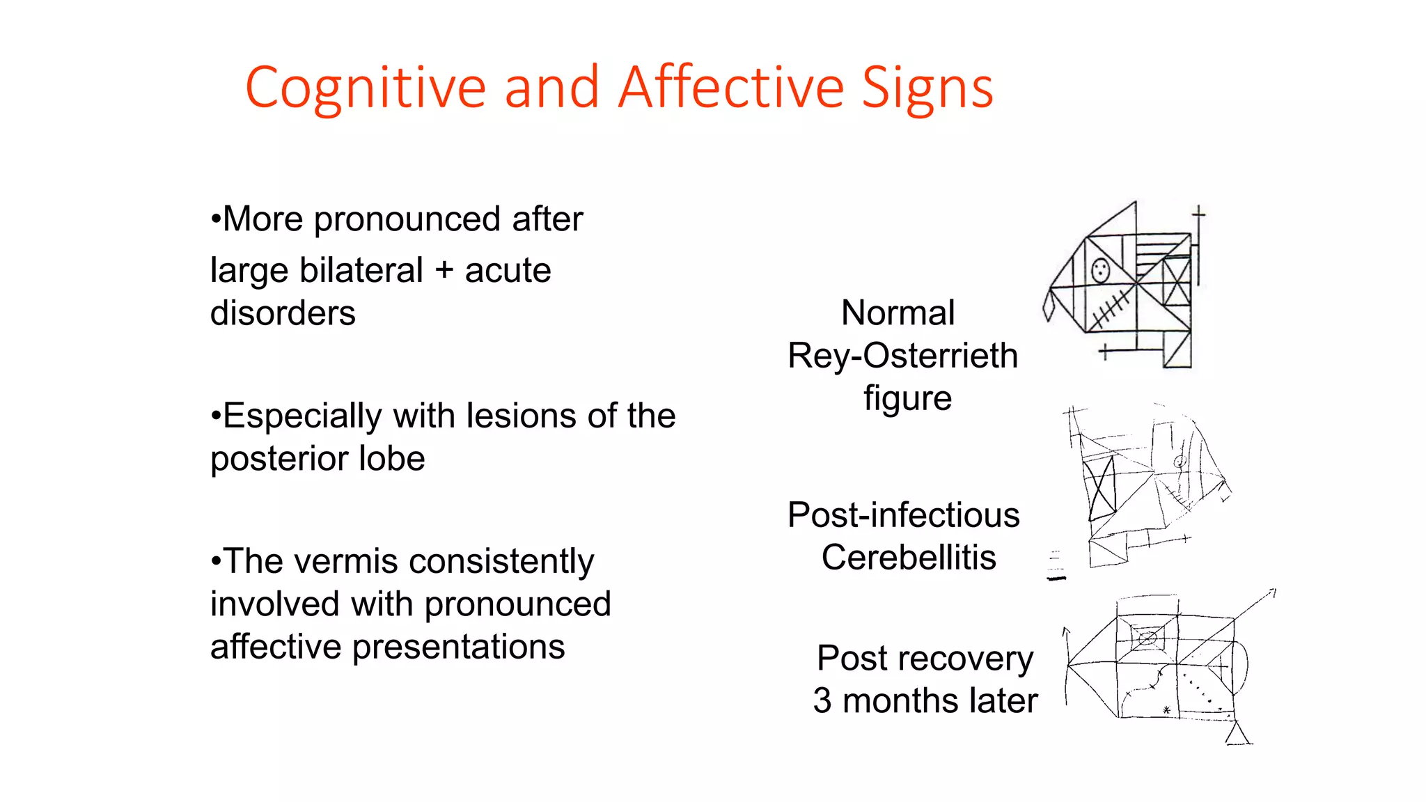 Cerebellar Ataxia in Multiple Sclerosis | PPTX