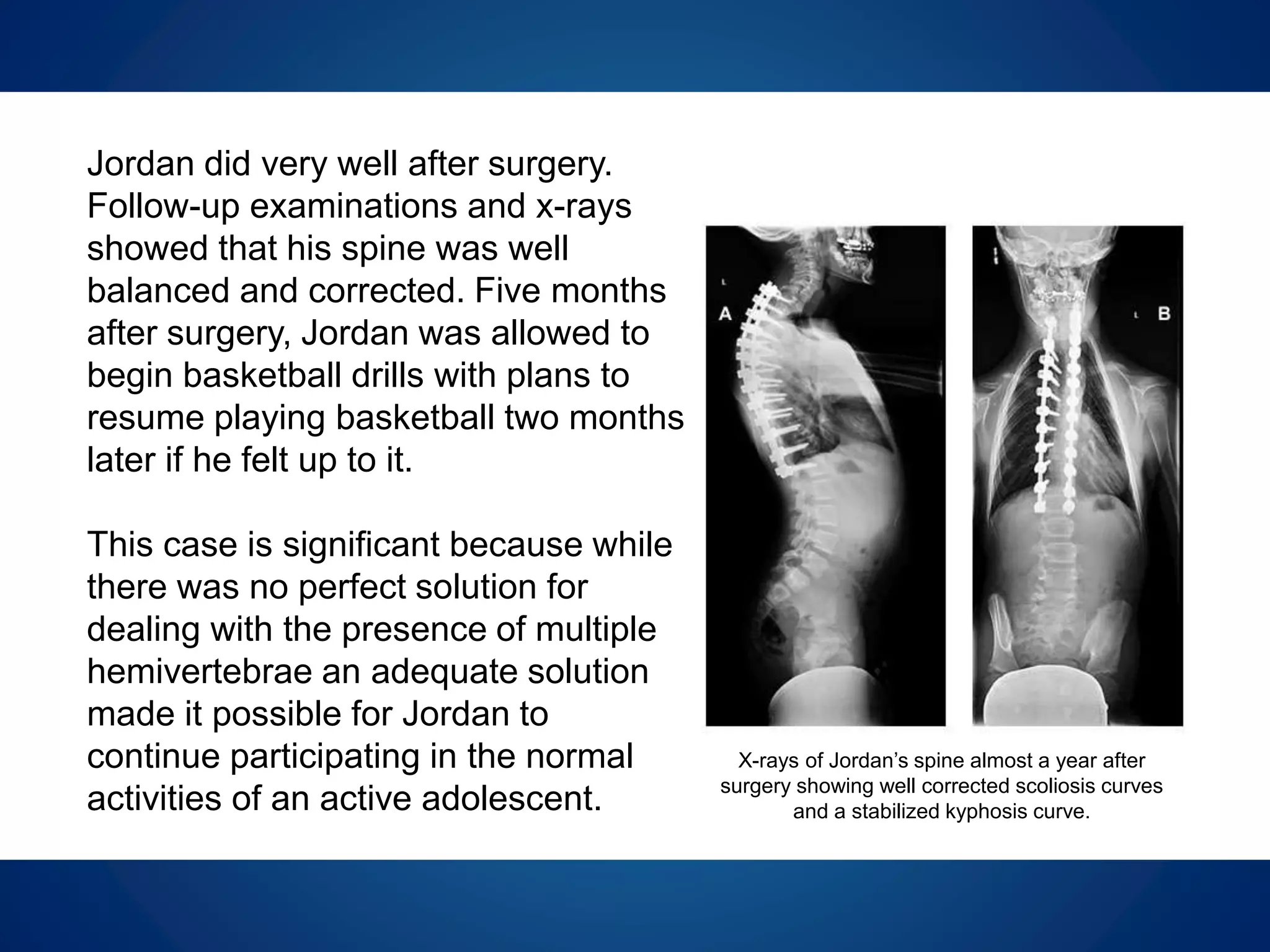 Jordan: Cleidocranial Dysostosis Case Study | PPTX