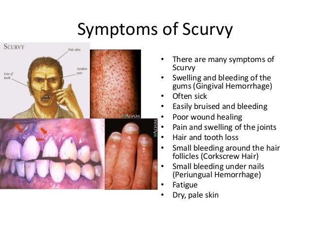 Jordan dougherty; scurvy