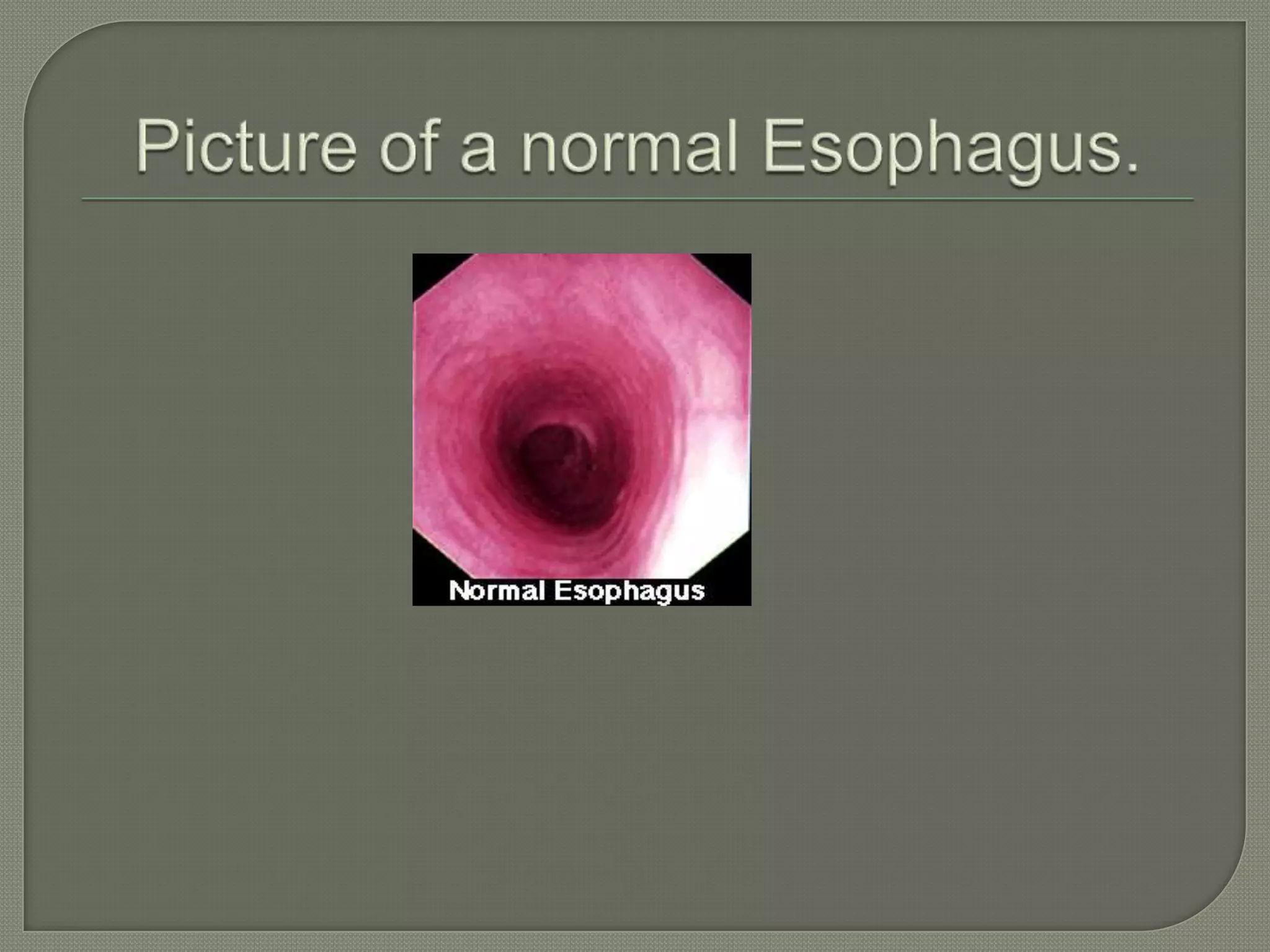 GI Disorders by Joe Zink | PPT