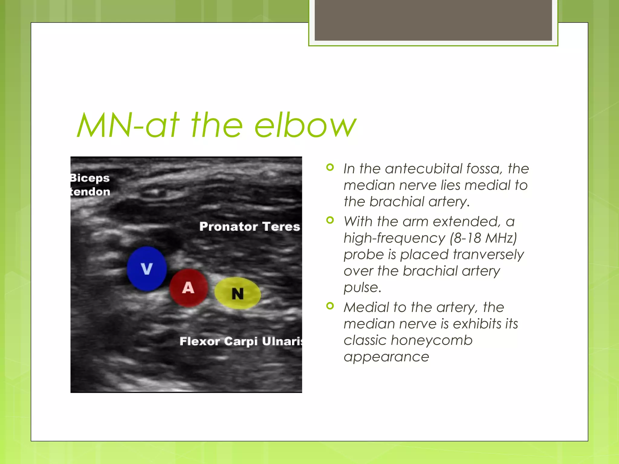 Ultrasound Guided Peripheral Nerve Blocks | PPT
