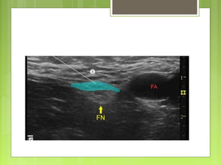 Ultrasound Guided Peripheral Nerve Blocks | PPT