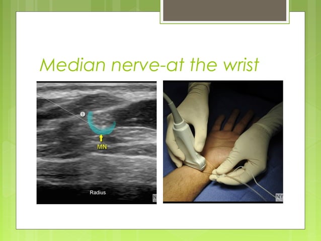 Ultrasound Guided Peripheral Nerve Blocks | PPT