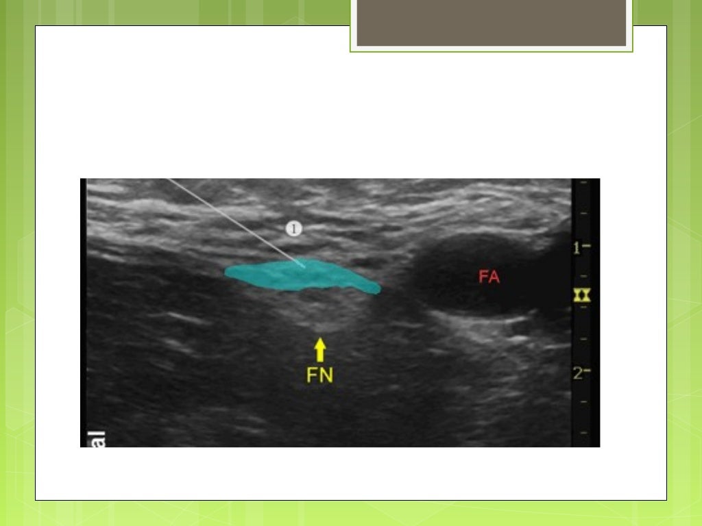 Ultrasound Guided Peripheral Nerve Blocks