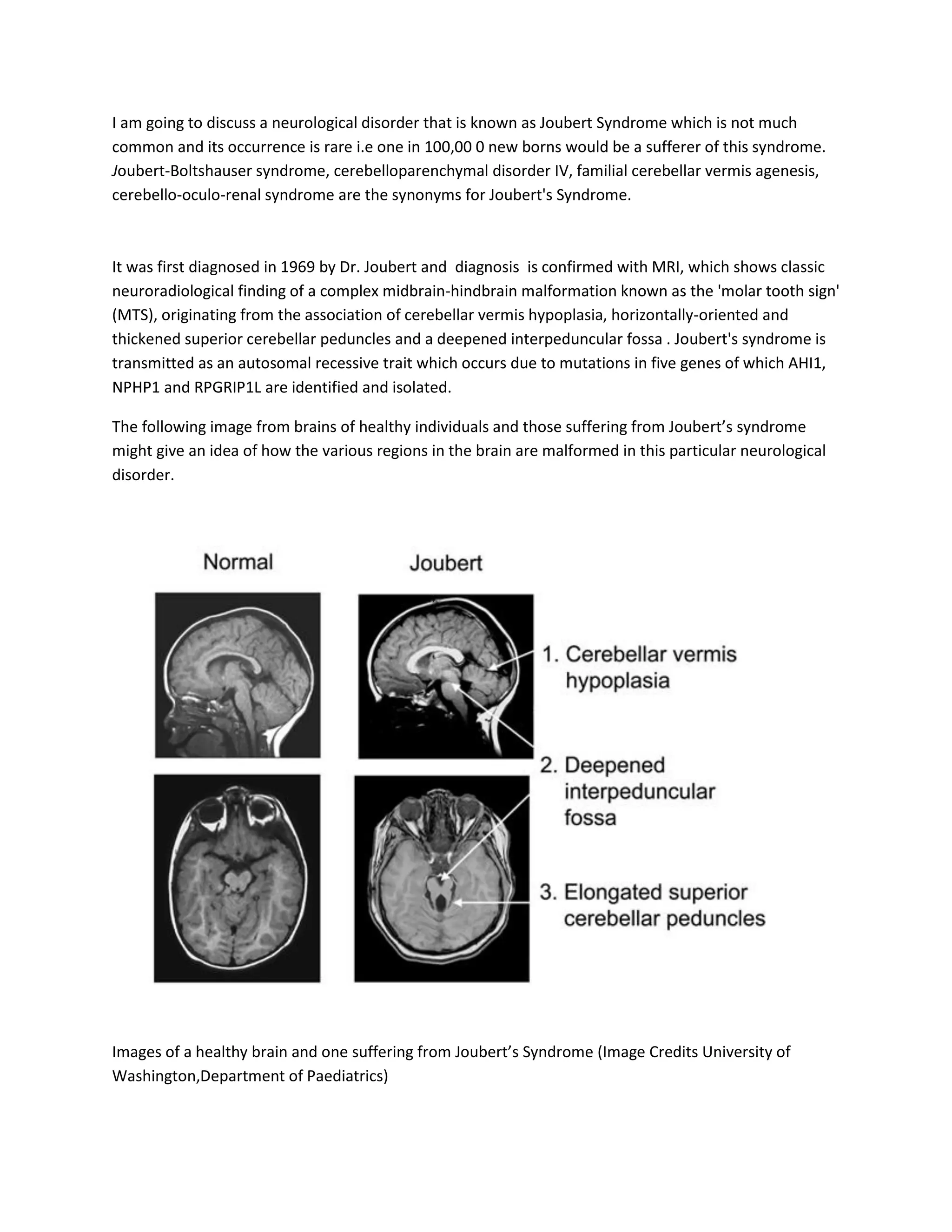 Joubert's syndrome | PDF