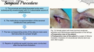Jourding-Etiology and prognosis of canalicular.pptx