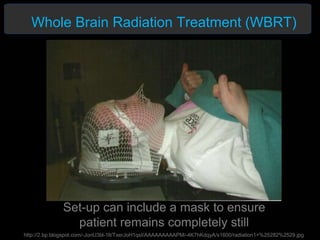 brain metastasis cancer | PPT