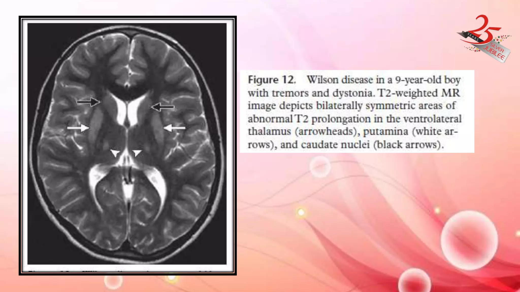 Bilateral Basal Ganglia Abnormalities Mri Pptx