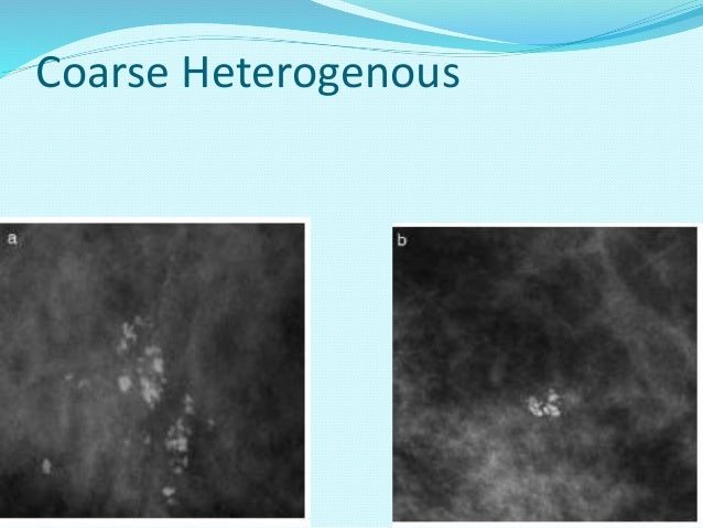Microcalcifications in Carcinoma Breast