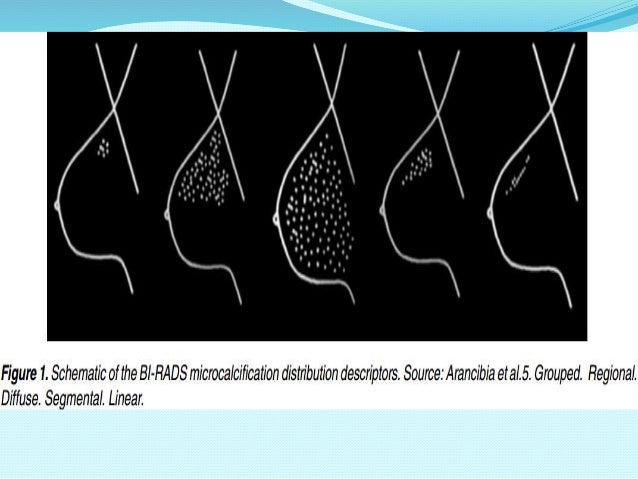 Microcalcifications in Carcinoma Breast