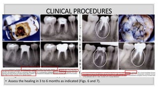 CLINICAL APPLICATIONS OF MTA | PPTX
