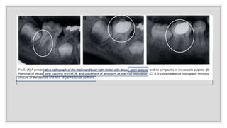CLINICAL APPLICATIONS OF MTA | PPTX
